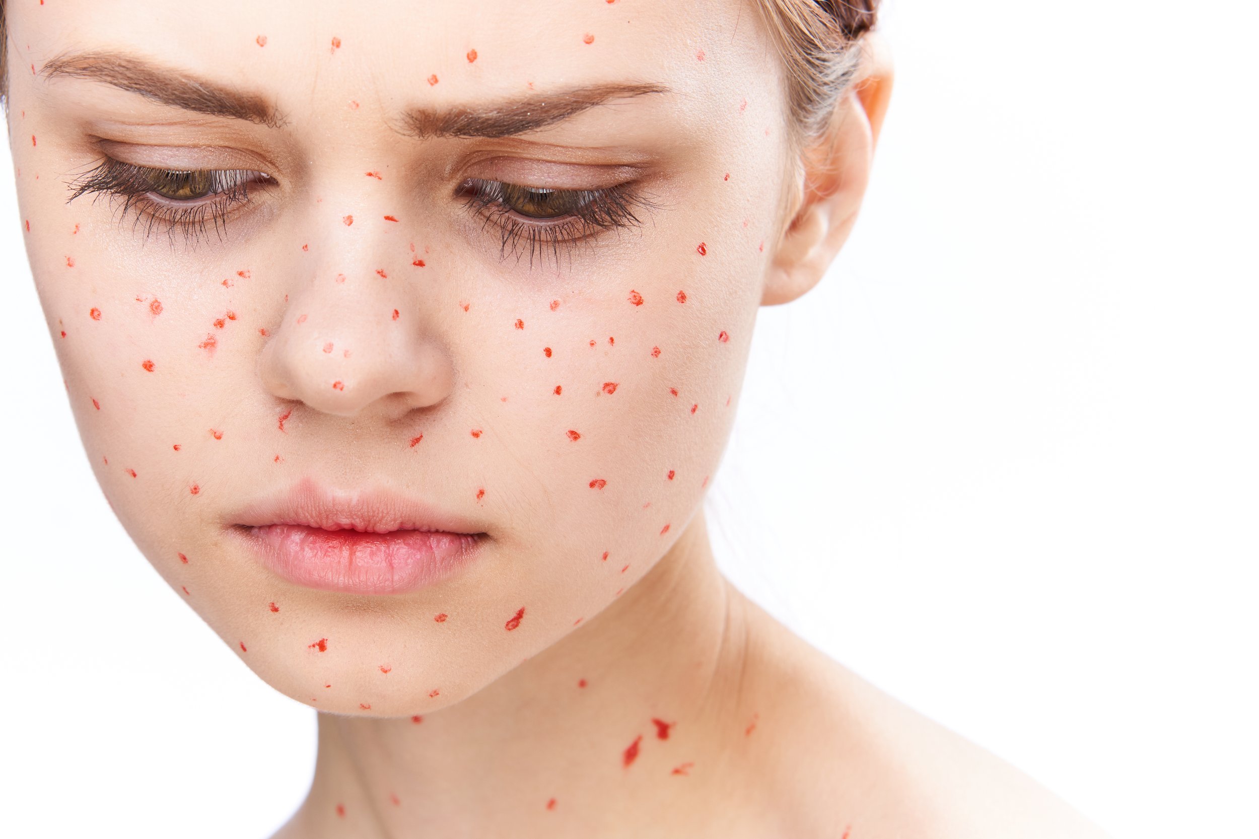 Varicella Zoster (Chickenpox)